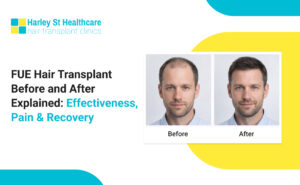 FUE Hair Transplant Before and After: Results & Recovery